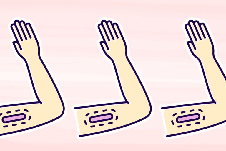 Health Canada Just Approved the Birth Control Arm Implant - FASHION ...