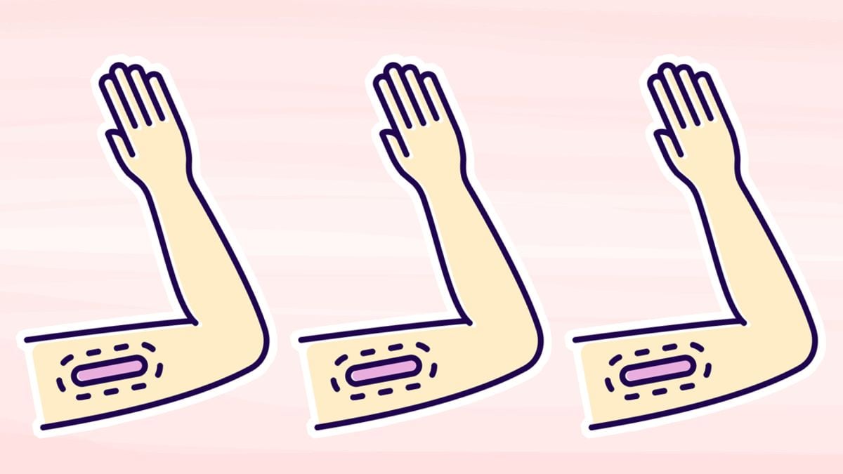 Health Canada Just Approved the Birth Control Arm Implant - FASHION ...