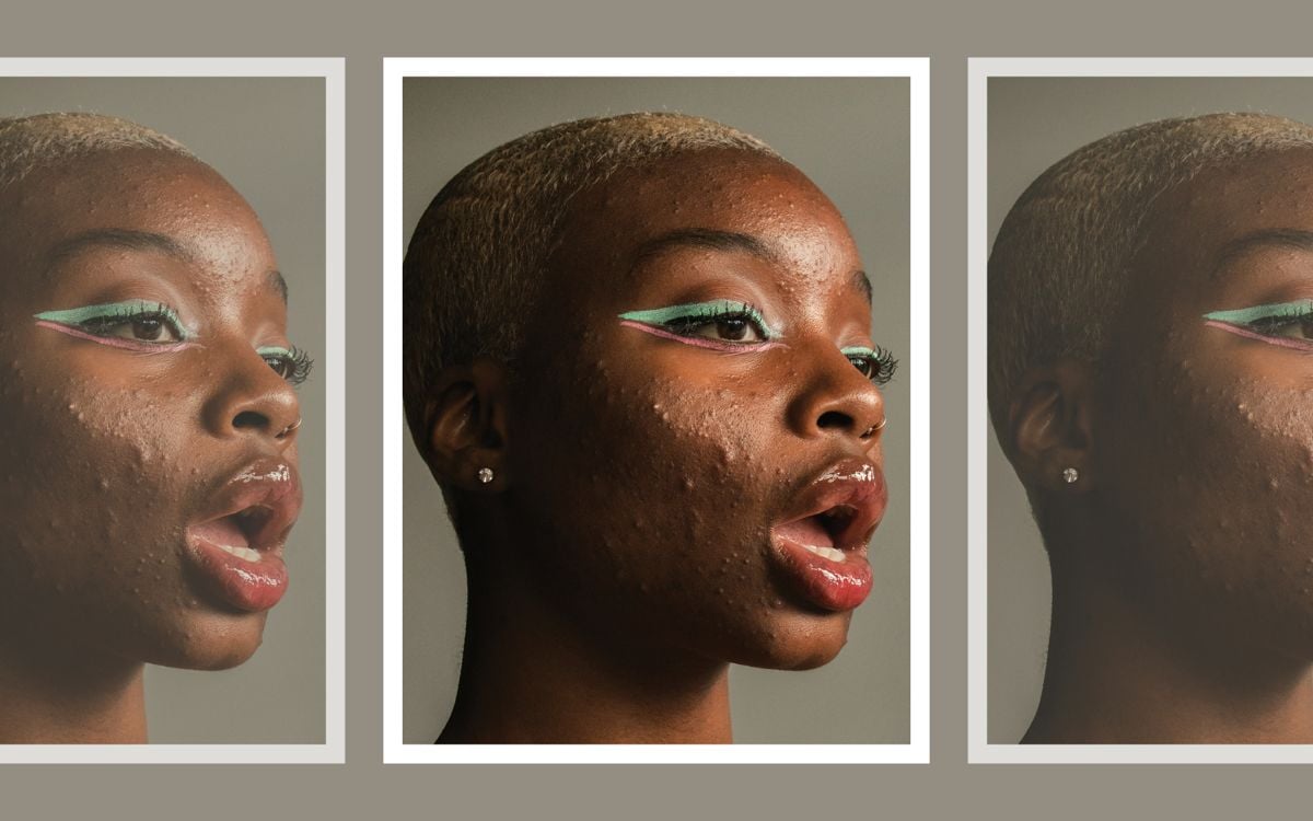 I Finally Realized That I Can't Let Acne Stop Me - FASHION Magazine I Finally Realized That I Can't Let Acne Stop Me - FASHION Magazine