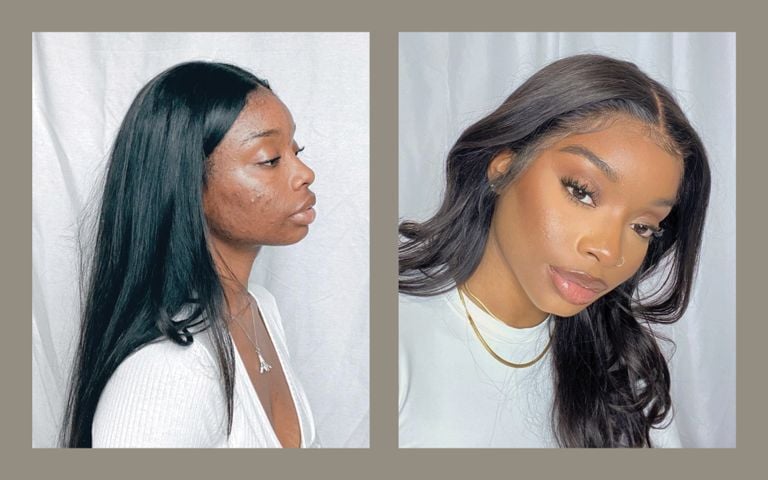 I Finally Realized That I Can't Let Acne Stop Me - FASHION Magazine I Finally Realized That I Can't Let Acne Stop Me - FASHION Magazine